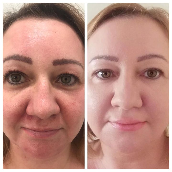 Upgrading clients to advanced facials - WOW facial